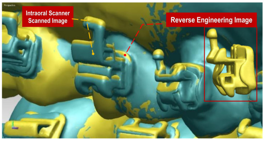 Three-Dimensional Digital Superimposition of Orthodontic Bracket ...