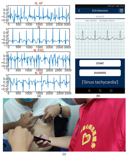 Sensors | Free Full-Text | Artificial Intelligence-Enabled ECG Algorithm Based on Improved ...