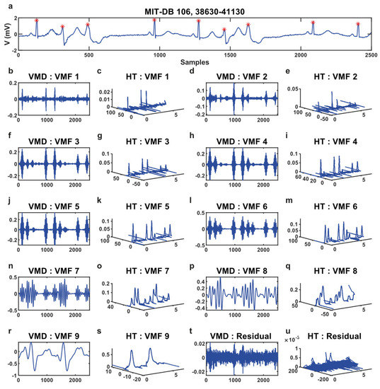 Improving R Peak Detection in ECG Signal Using Dynamic Mode Selected Energy and Adaptive Window ...