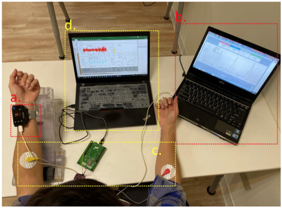 Piezoelectric Sensor for the Monitoring of Arterial Pulse Wave: Detection of Arrhythmia ...