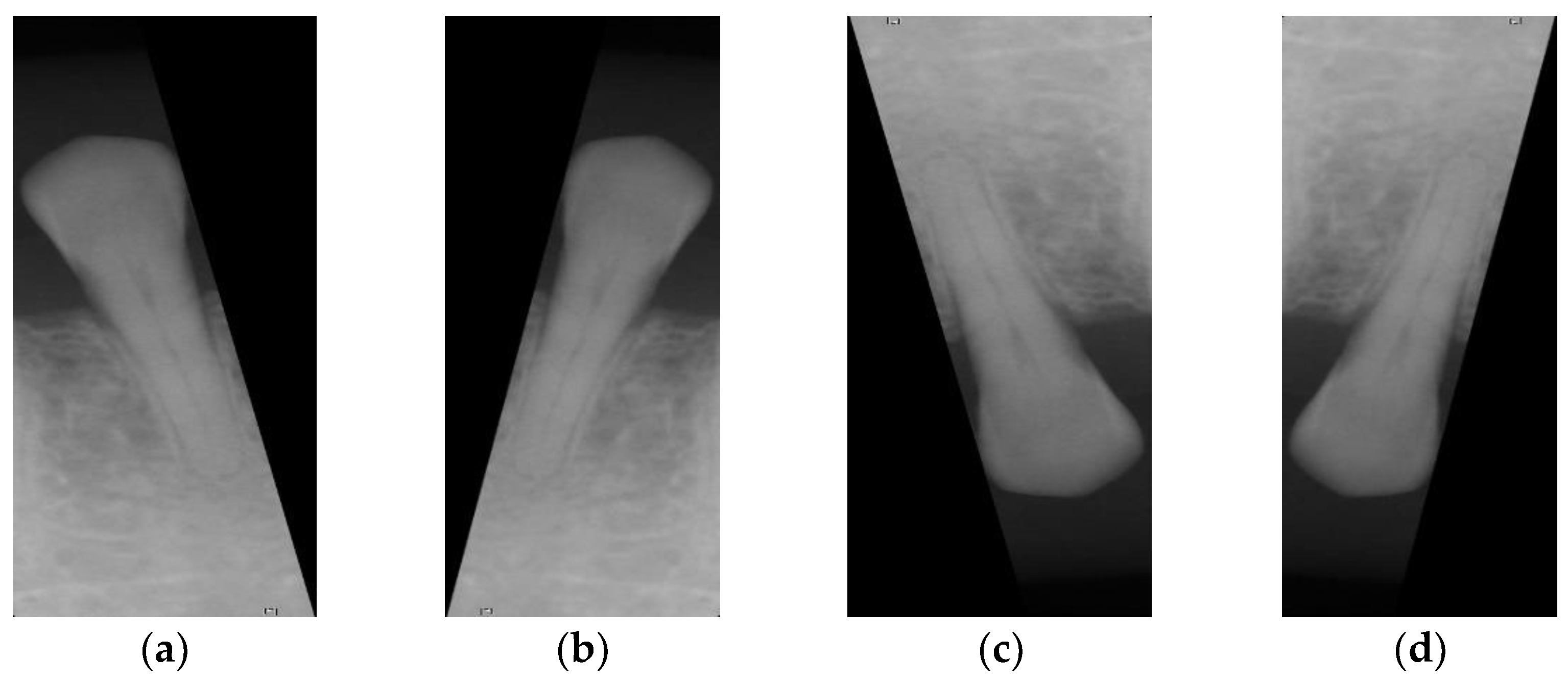Detection of Dental Apical Lesions Using CNNs on Periapical Radiograph