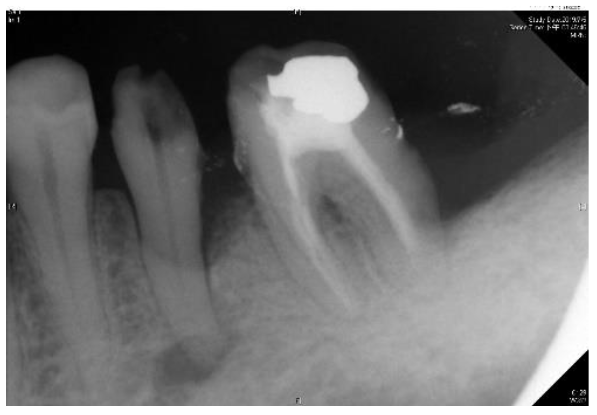 Detection of Dental Apical Lesions Using CNNs on Periapical Radiograph