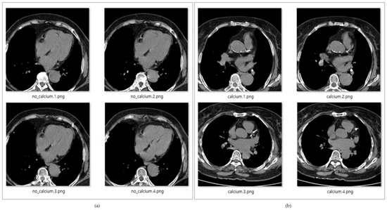 Deep-Learning-Based Coronary Artery Calcium Detection from CT Image