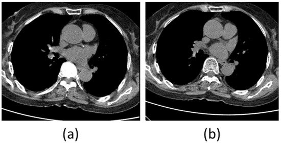Deep-Learning-Based Coronary Artery Calcium Detection from CT Image