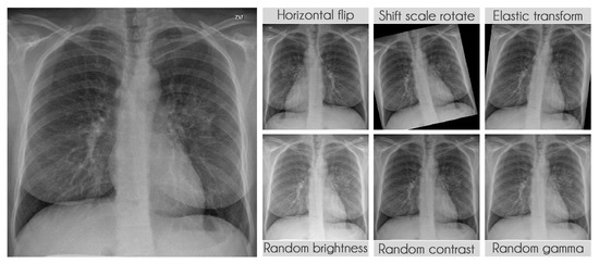 Sensors | Free Full-Text | Impact of Lung Segmentation on the Diagnosis ...