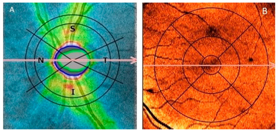 Optical Coherence Tomography in the Differential Diagnosis of Patients ...
