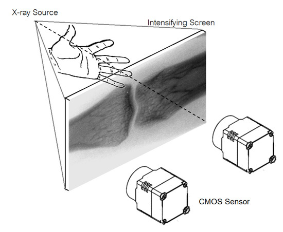 Bone Mineral Density Screening System Using CMOS-Sensor X-ray Detector