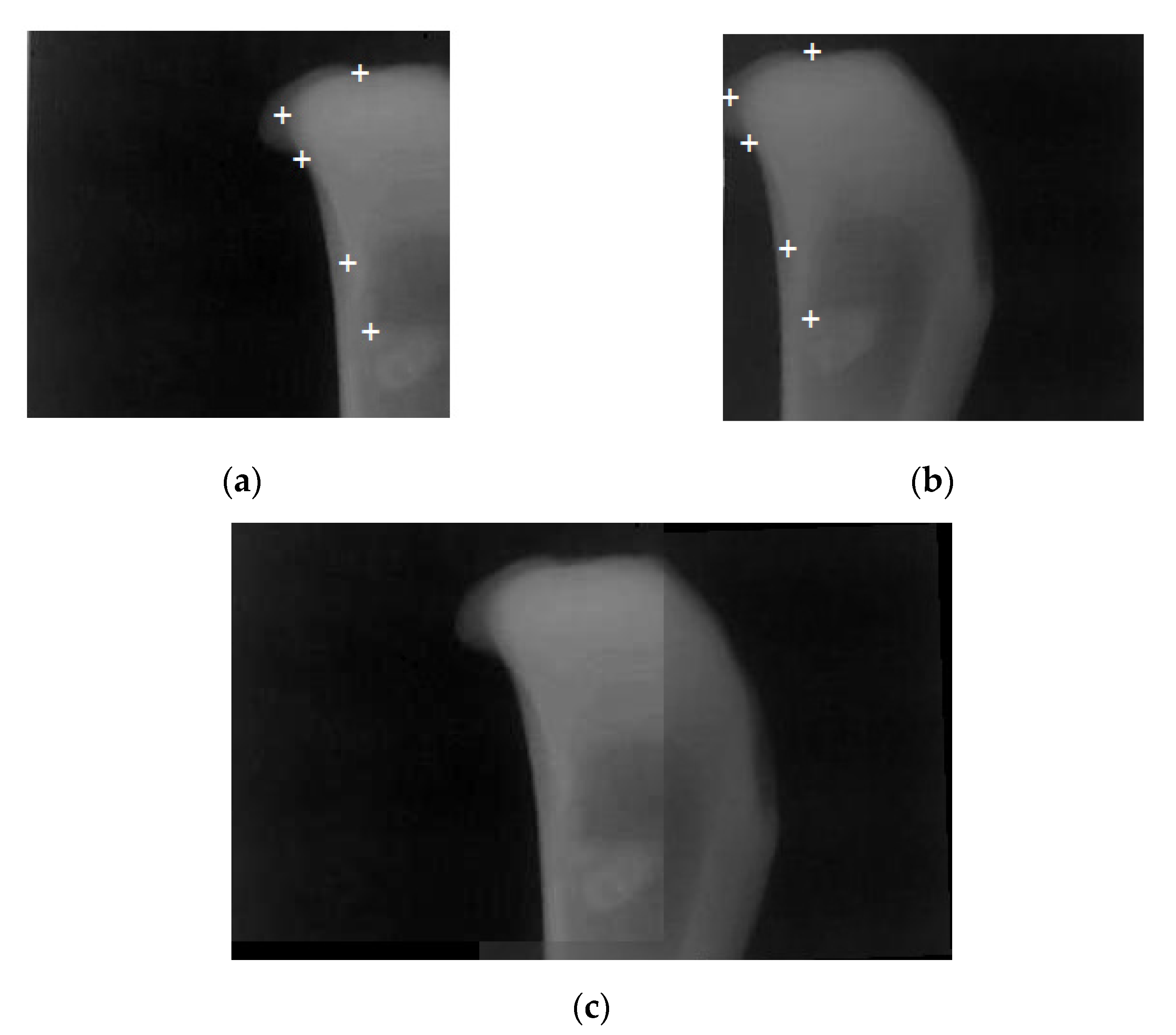 Bone Mineral Density Screening System Using CMOS-Sensor X-ray Detector
