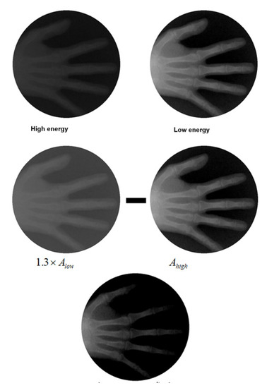 Bone Mineral Density Screening System Using CMOS-Sensor X-ray Detector