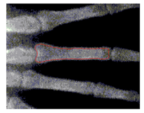 Bone Mineral Density Screening System Using CMOS-Sensor X-ray Detector
