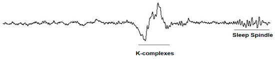 Automatic Detection of K-Complexes Using the Cohen Class Recursiveness and Reallocation Method ...