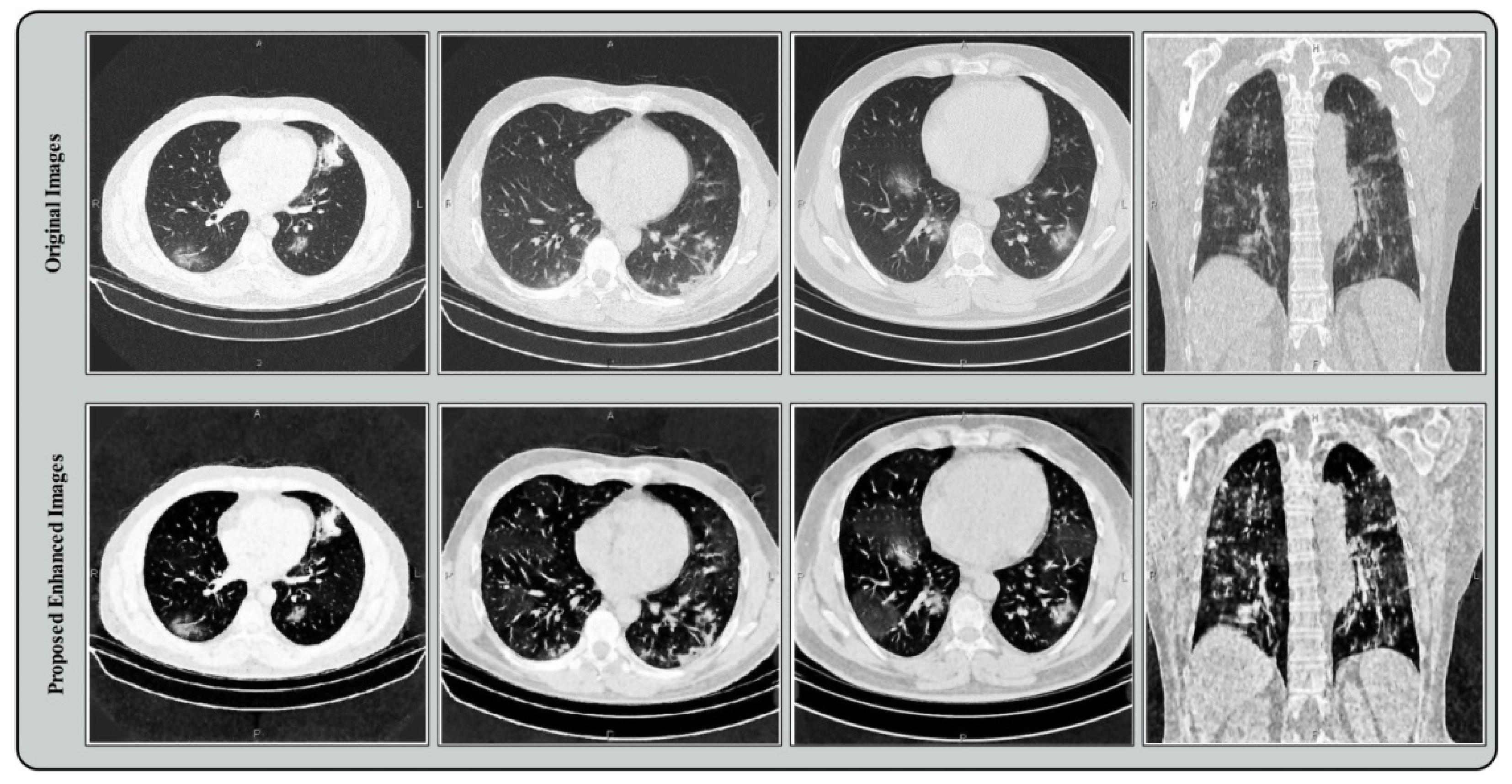 COVID-19 Case Recognition from Chest CT Images by Deep Learning ...