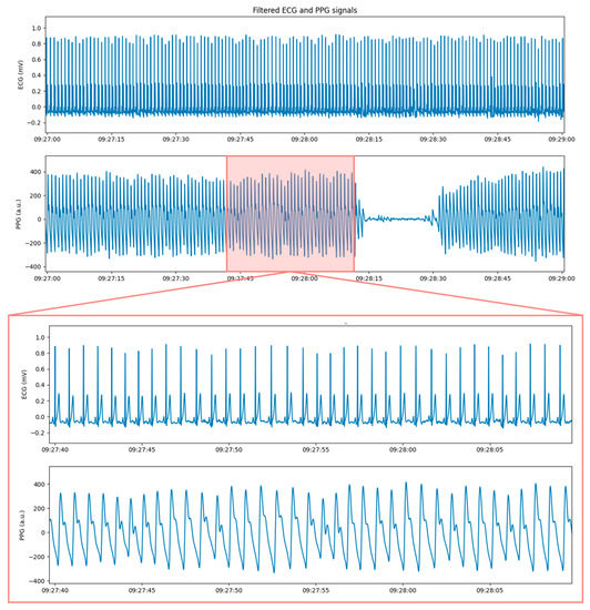 Blood Pressure Continuous Measurement through a Wearable Device ...