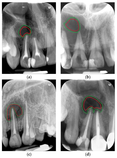 Radicular Cyst Radiology