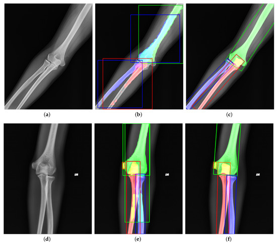 Accurate Instance Segmentation in Pediatric Elbow Radiographs