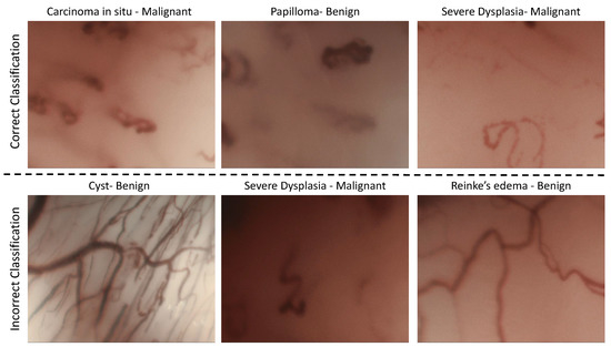 Deep Convolution Neural Network for Laryngeal Cancer Classification on ...