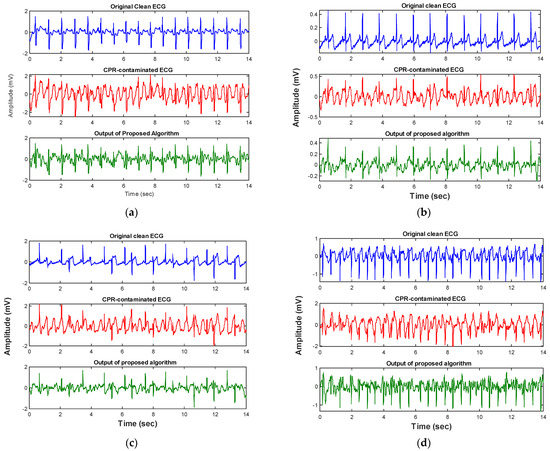 Automated Condition-Based Suppression of the CPR Artifact in ECG Data ...