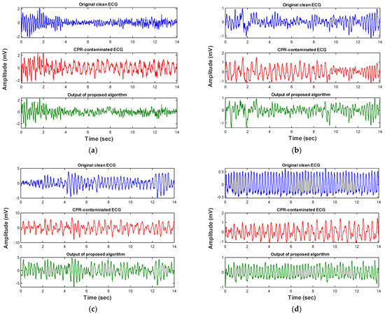 Automated Condition-Based Suppression of the CPR Artifact in ECG Data ...
