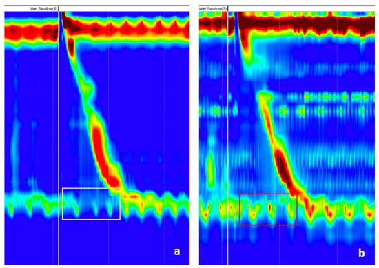 Upper Esophageal Sphincter Manometry