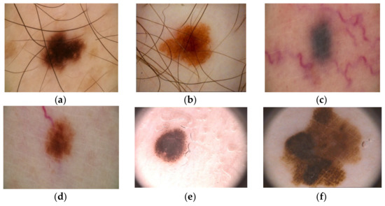 Sensors | Free Full-Text | New Trends in Melanoma Detection Using ...