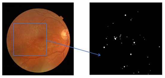 Sensors | Free Full-Text | Deep Learning Approach for Automatic Microaneurysms Detection