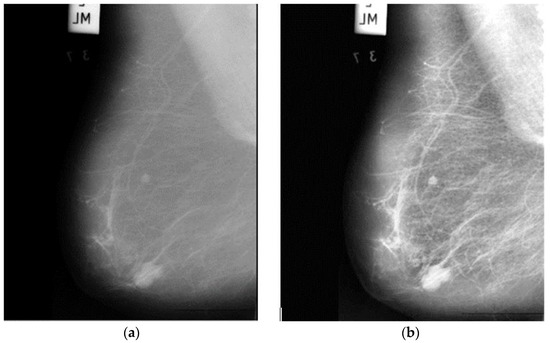 Automated Breast Cancer Detection Models Based on Transfer Learning