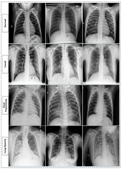 Chest X-ray Classification for the Detection of COVID-19 Using Deep Learning Techniques