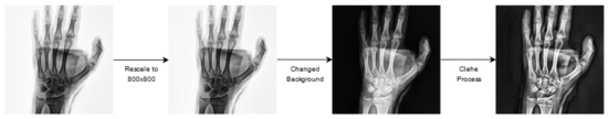 Fracture Detection in Wrist X-ray Images Using Deep Learning-Based Object Detection Models