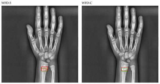 Fracture Detection in Wrist X-ray Images Using Deep Learning-Based Object Detection Models