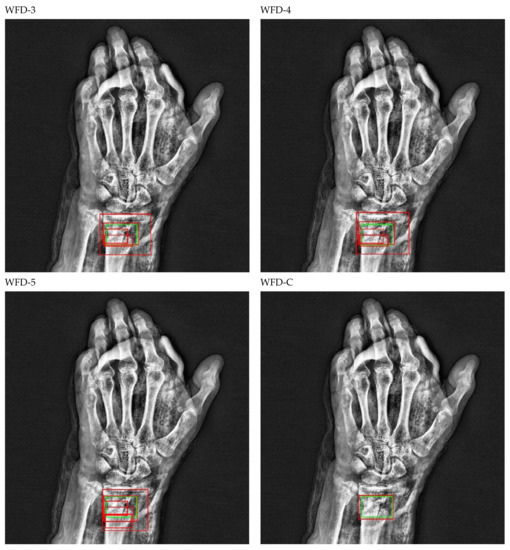 X Ray Hand Bones Fracture Detection In Wrist X Ray Images Using Deep