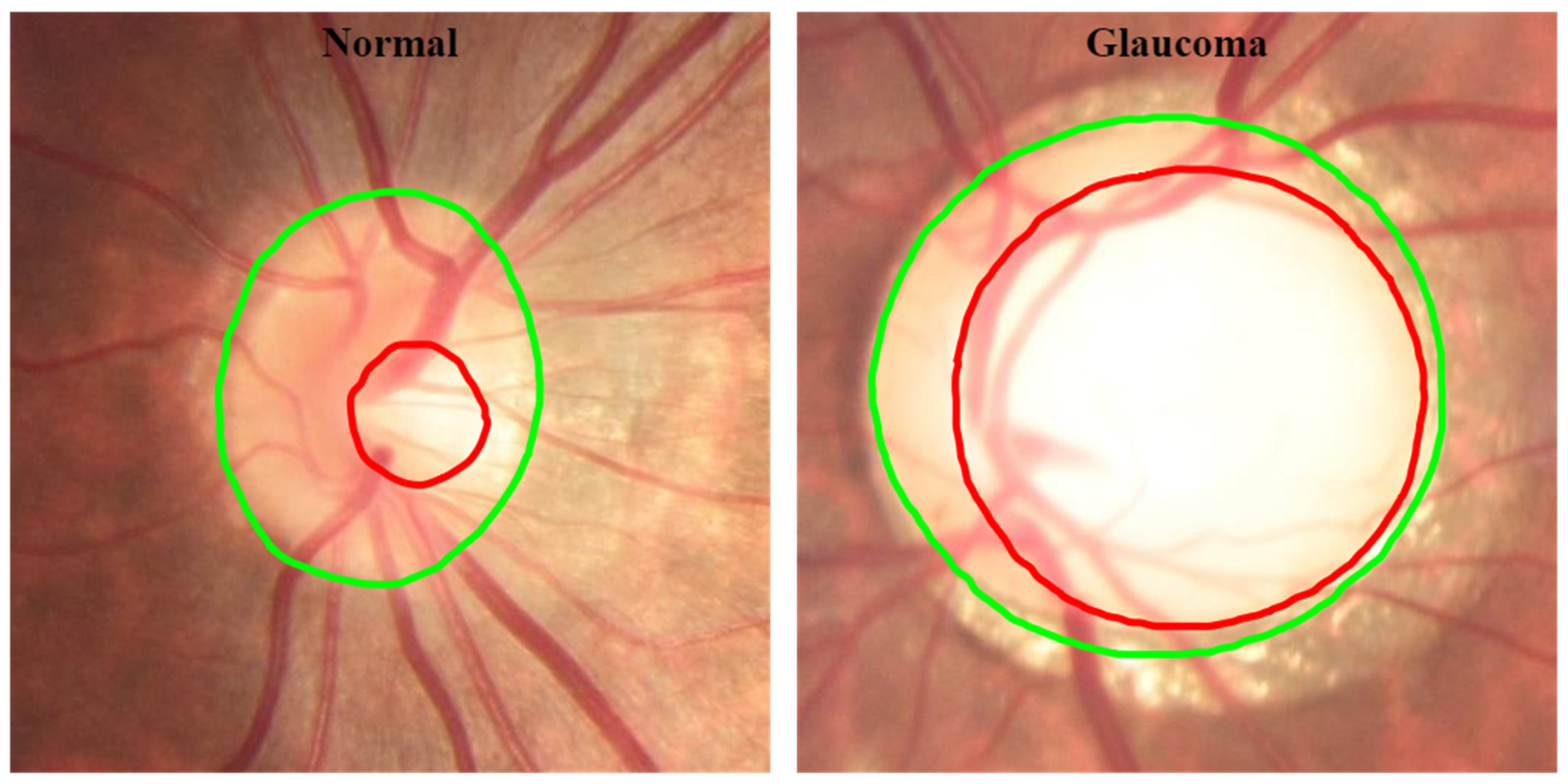 Evaluations of Deep Learning Approaches for Glaucoma Screening Using ...