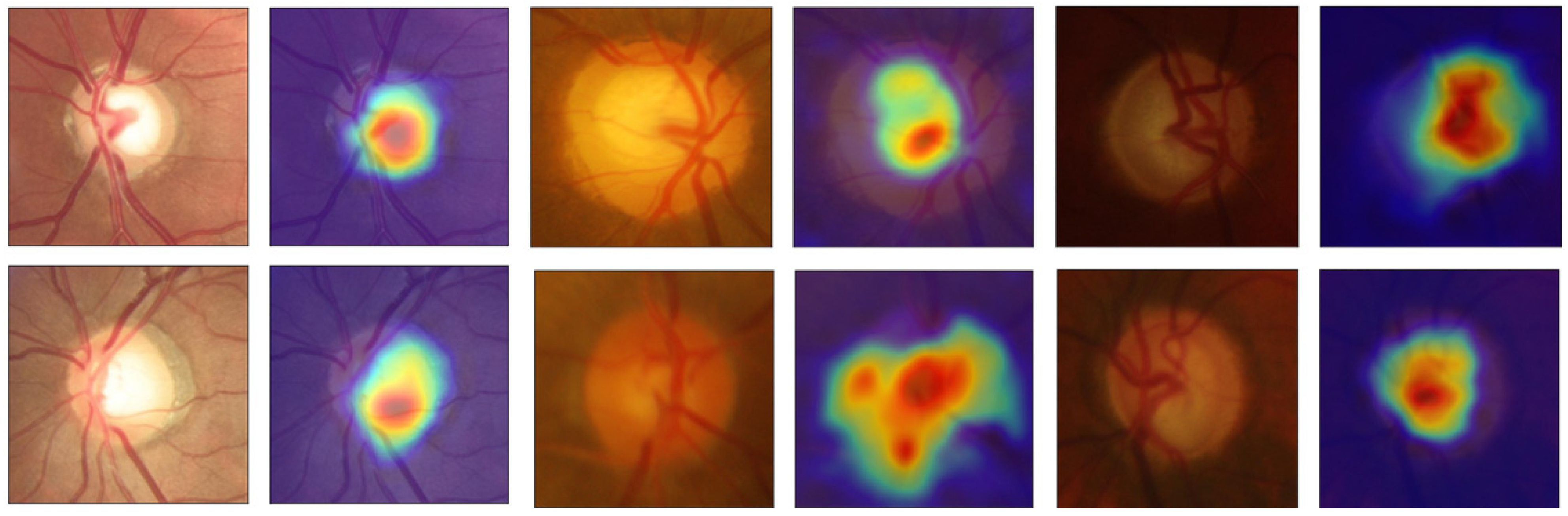 Evaluations of Deep Learning Approaches for Glaucoma Screening Using ...