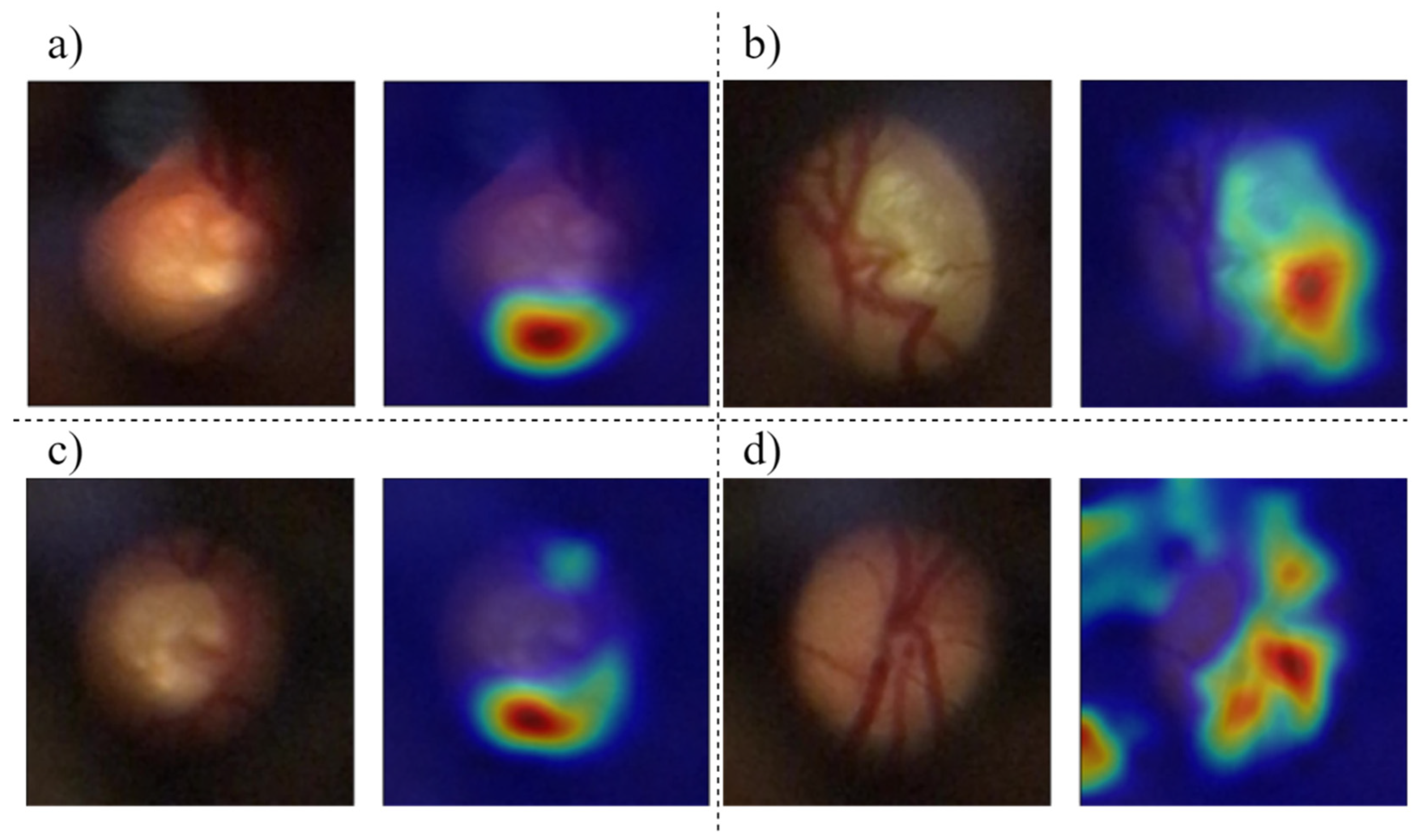 Evaluations of Deep Learning Approaches for Glaucoma Screening Using ...