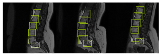 Localization and Edge-Based Segmentation of Lumbar Spine Vertebrae to ...