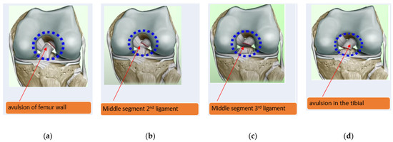 Automated Knee MR Images Segmentation of Anterior Cruciate Ligament Tears
