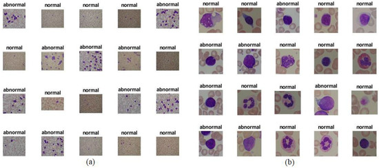 Multi-Method Diagnosis of Blood Microscopic Sample for Early Detection of Acute Lymphoblastic ...