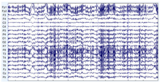 Auto-Denoising for EEG Signals Using Generative Adversarial Network