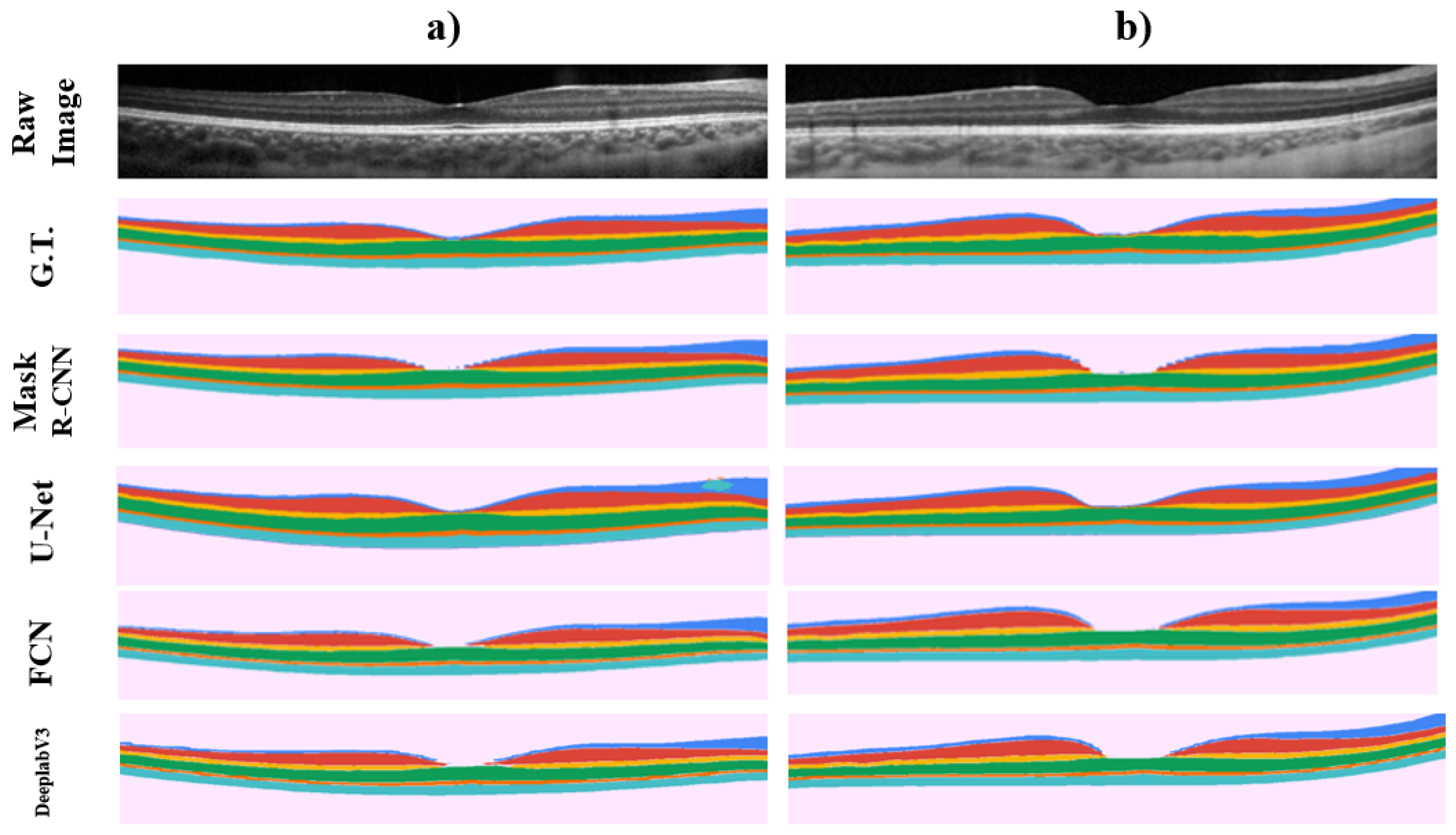 Sensors | Free Full-Text | OCT Retinal and Choroidal Layer Instance Segmentation Using Mask R-CNN