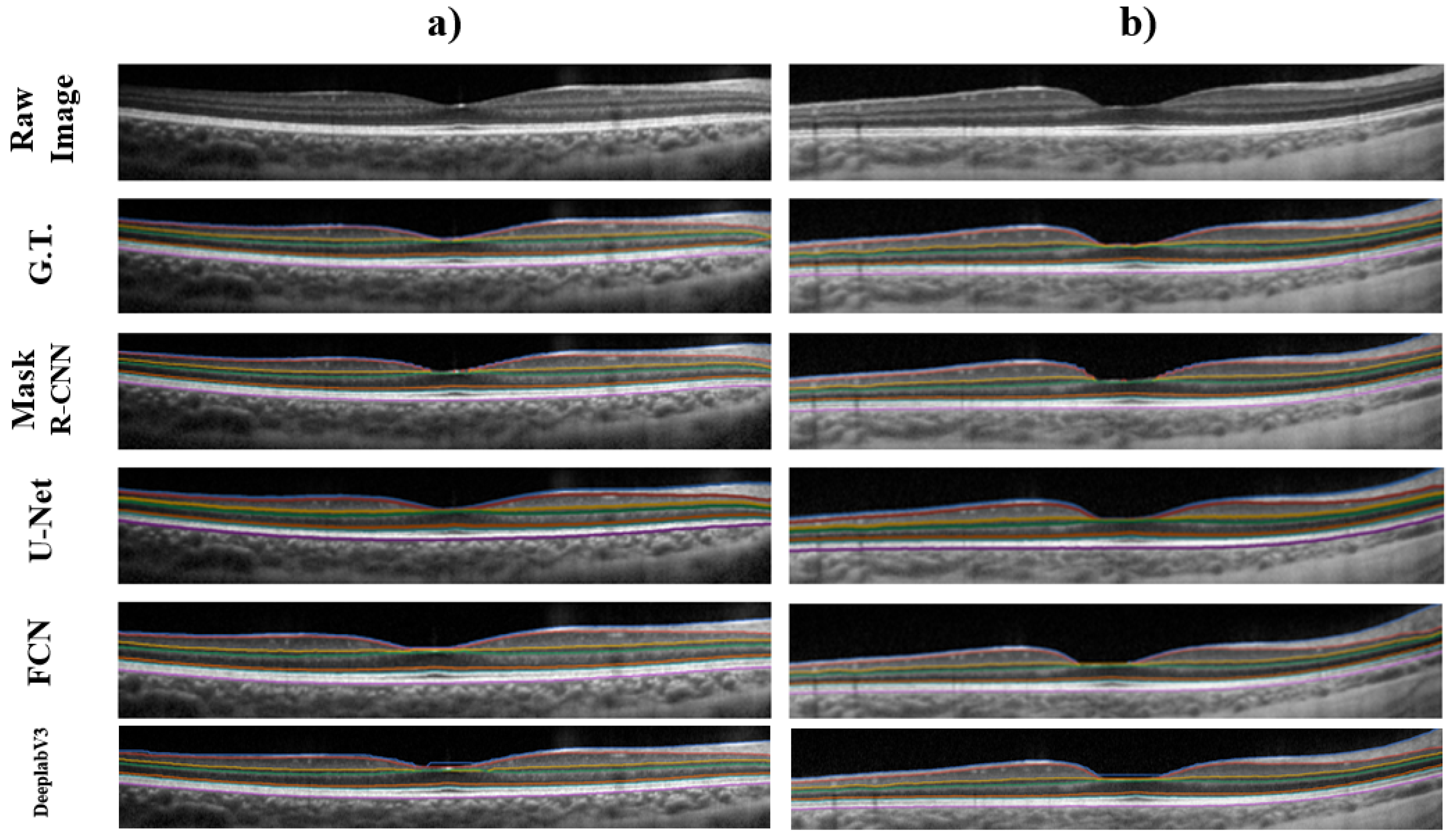 Sensors | Free Full-Text | OCT Retinal and Choroidal Layer Instance Segmentation Using Mask R-CNN