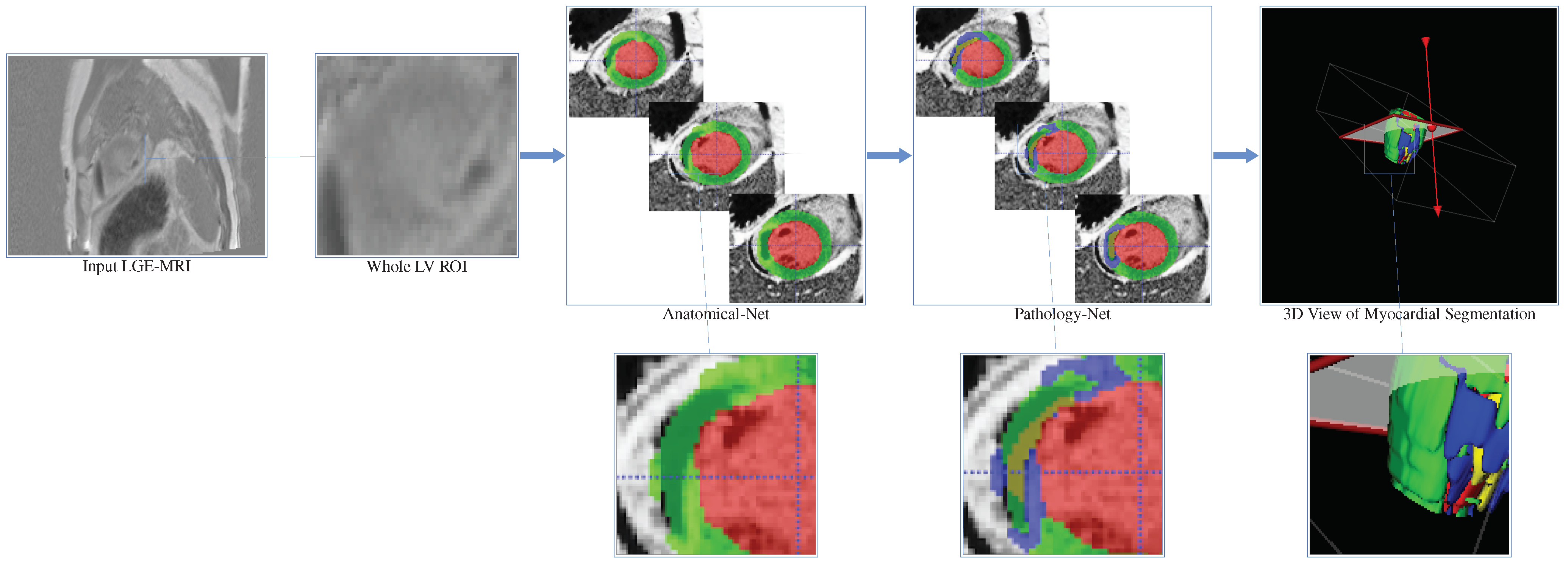 An Improved 3D Deep Learning-Based Segmentation of Left Ventricular Myocardial Diseases from ...