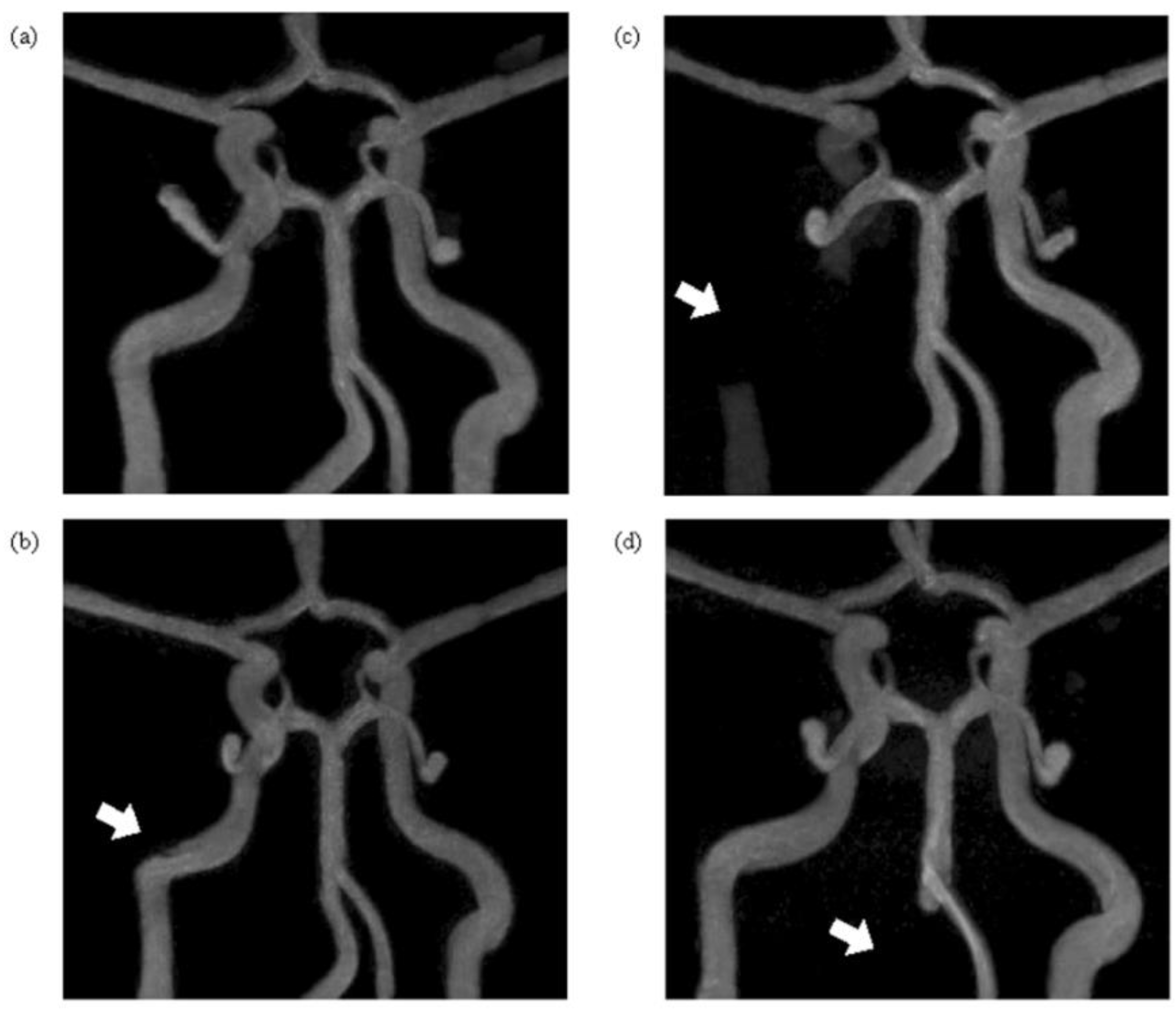 Investigation of Flow Changes in Intracranial Vascular Disease Models ...