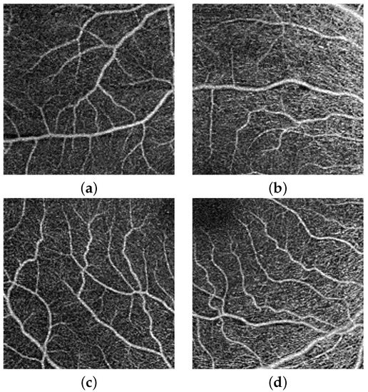 Automated Diagnosis of Optical Coherence Tomography Angiography (OCTA ...