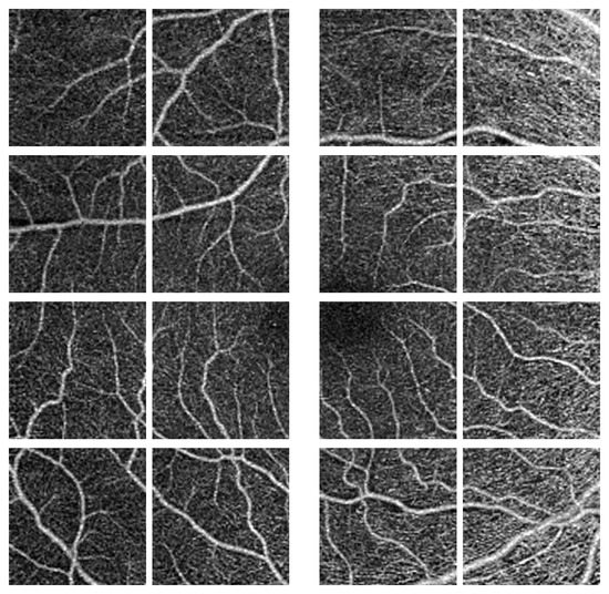 Automated Diagnosis of Optical Coherence Tomography Angiography (OCTA ...