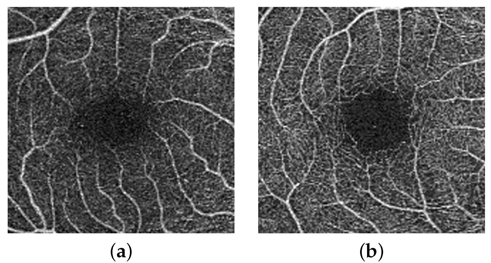 Automated Diagnosis of Optical Coherence Tomography Angiography (OCTA ...