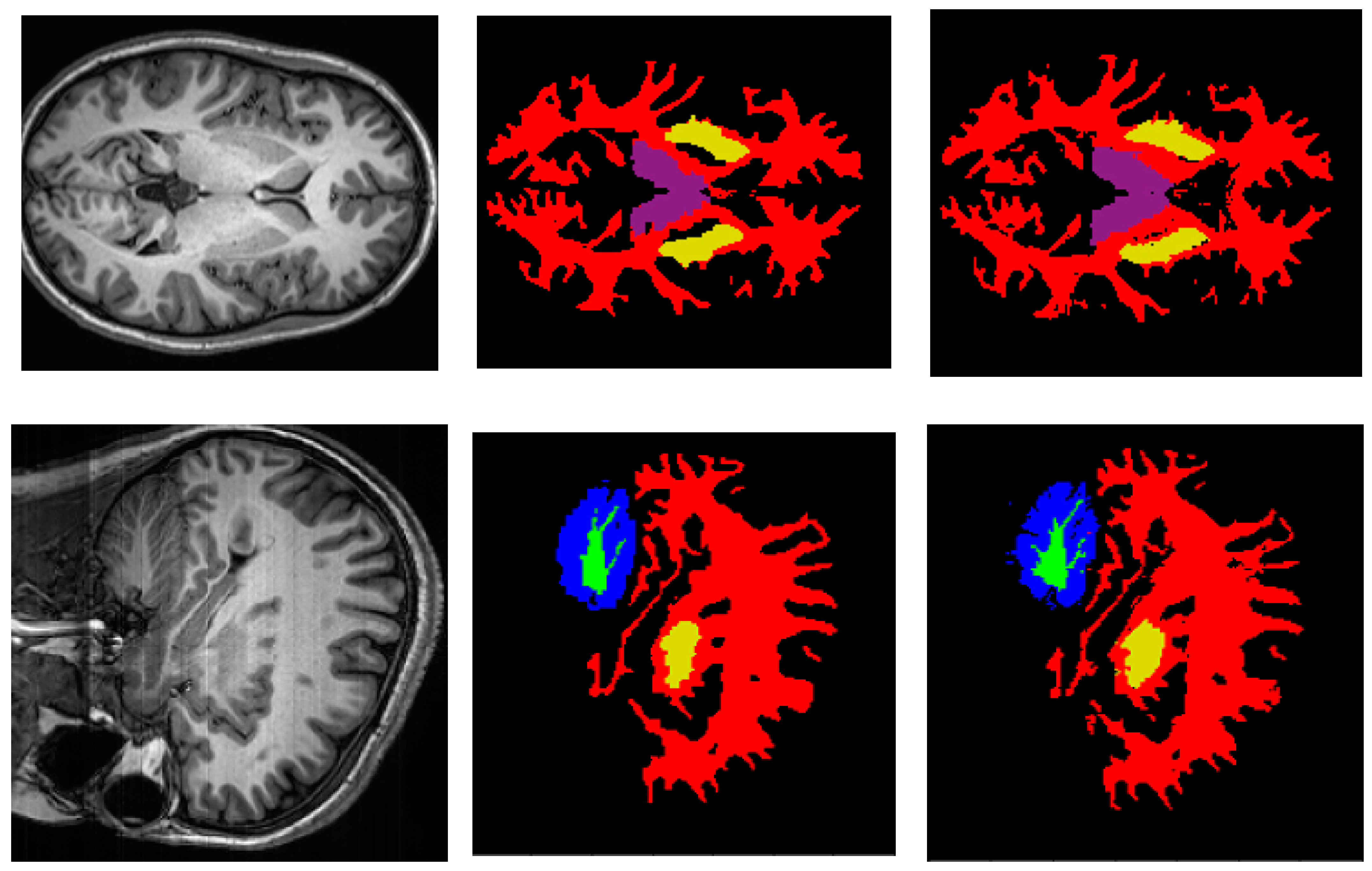 Deep 3d Neural Network For Brain Structures Segmentation Using Self Attention Modules In Mri Images