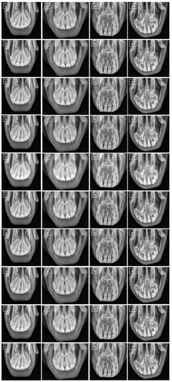 Selection of Filtering and Image Texture Analysis in the Radiographic ...