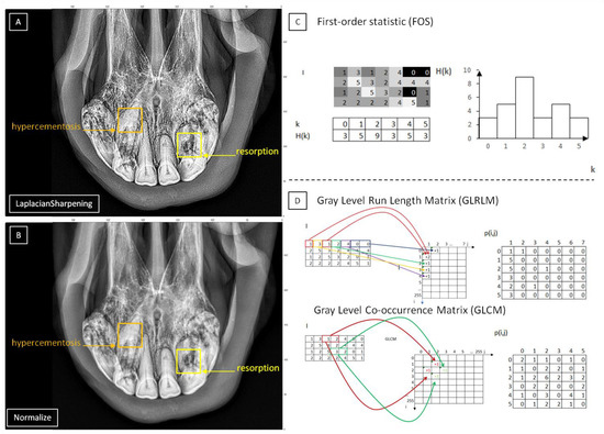 Selection of Filtering and Image Texture Analysis in the Radiographic ...