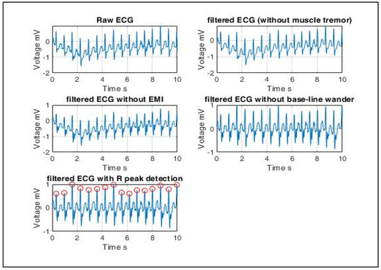 mm-Wave Radar-Based Vital Signs Monitoring and Arrhythmia Detection ...