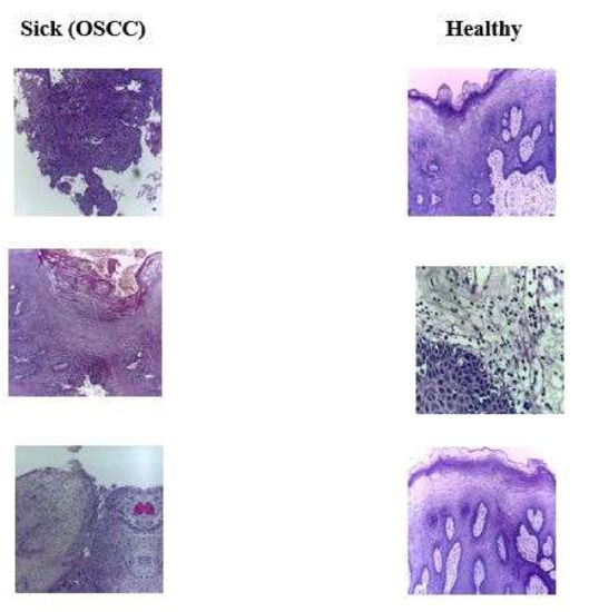 Histopathologic Oral Cancer Prediction Using Oral Squamous Cell ...