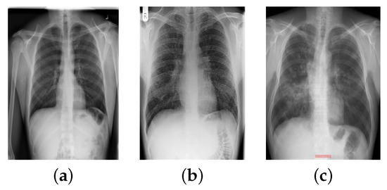 Reliable Sarcoidosis Detection Using Chest X-rays with EfficientNets ...